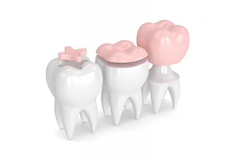 Inlays and Onlays - Knowle Dental Practice